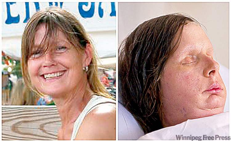 Woman mauled by chimp reveals her new face – Winnipeg Free Press