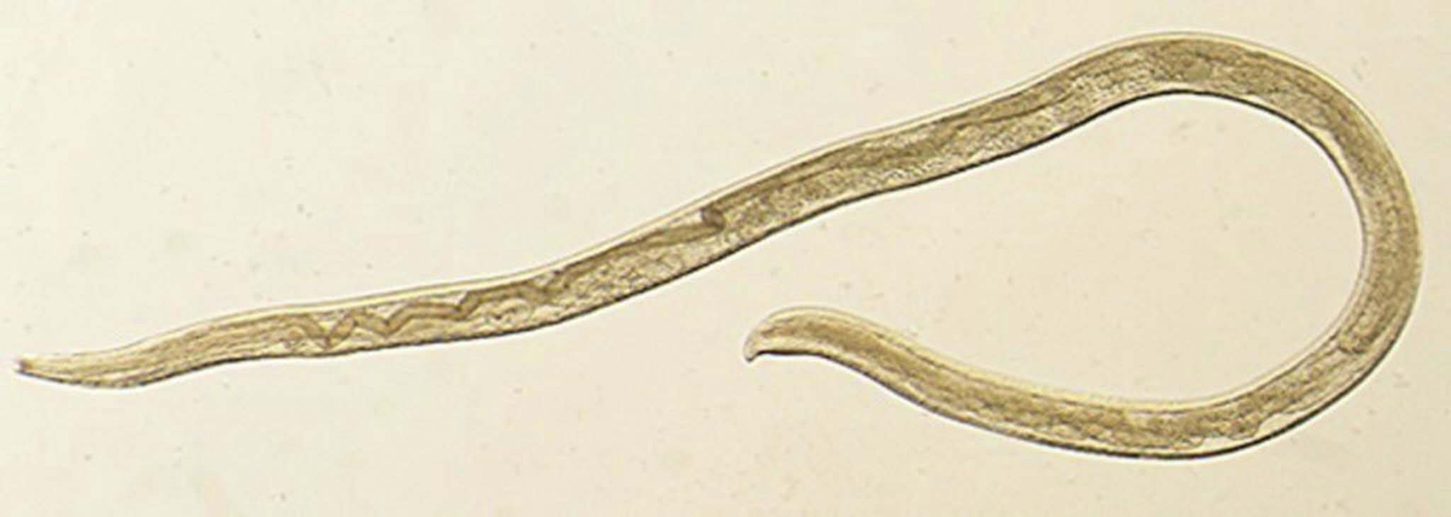 Case of eye worms makes medical history – Winnipeg Free Press