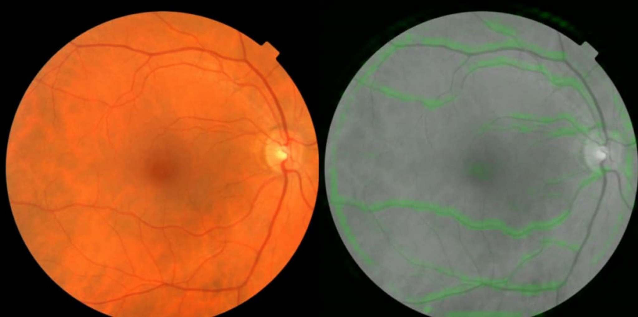 Google eyes new way to predict heart disease – Winnipeg Free Press