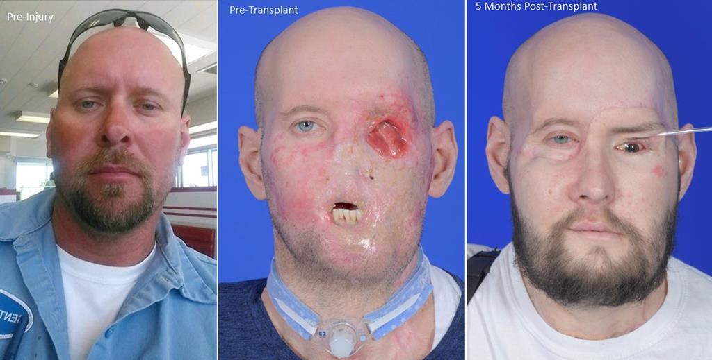 Man receives the first eye transplant plus a new face. It’s a step ...